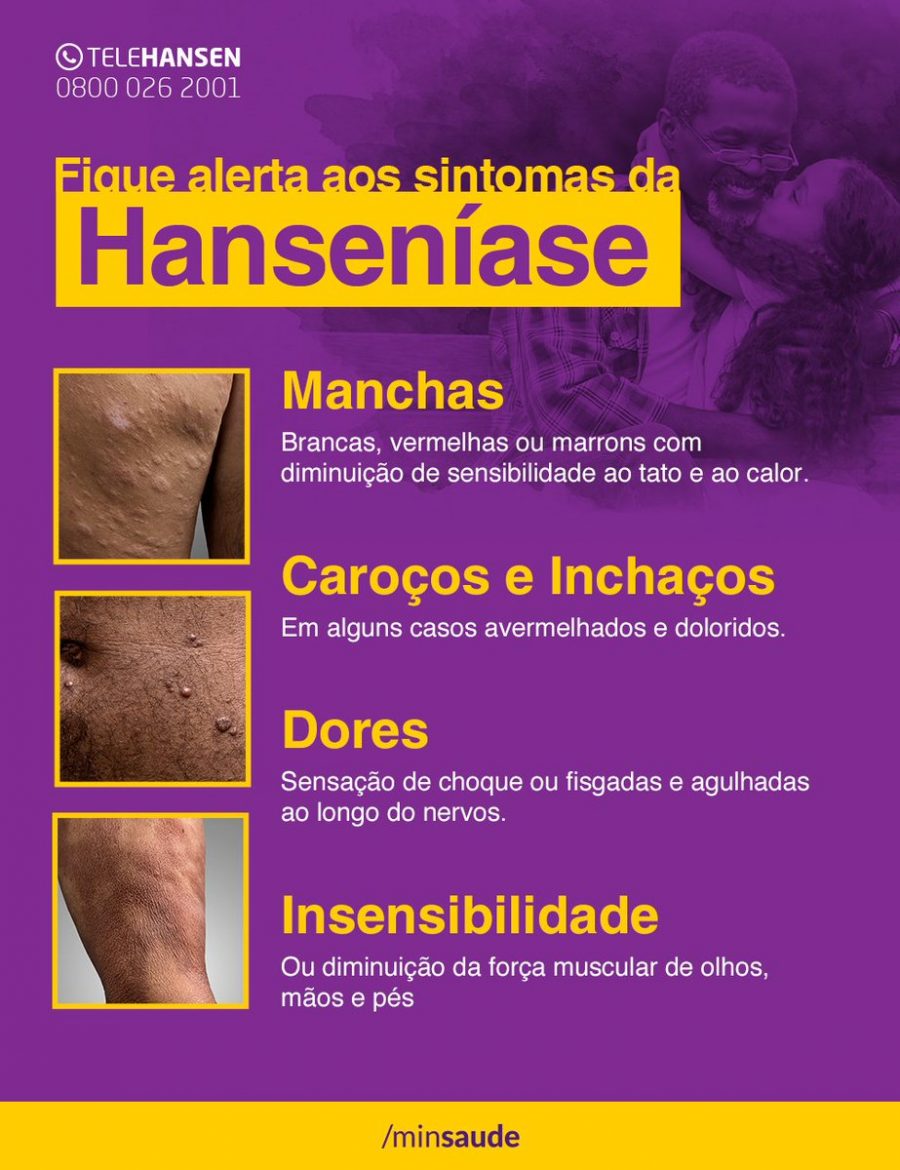Hanseníase: que mancha é essa? – Laboratório Gerardo Trindade